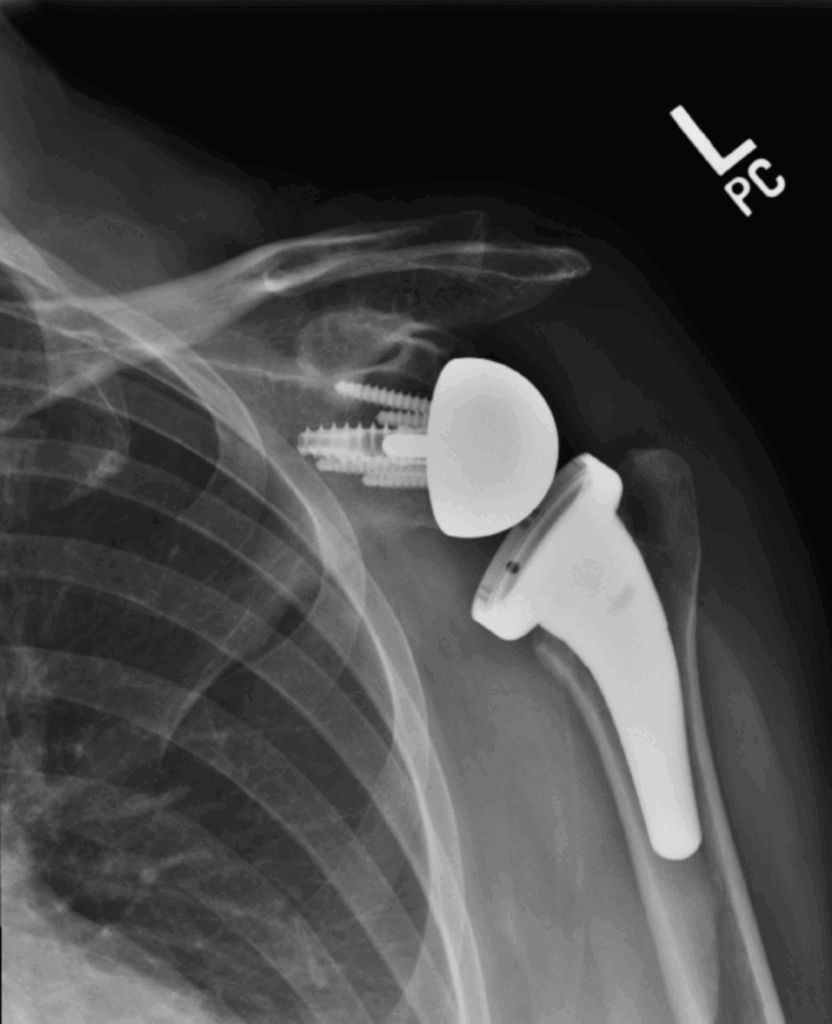 Reverse Shoulder Replacement FAQ s Dr McClintock Roseville CA